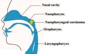 Nasopharyngeal Carcinoma - Symptoms, Survival Rate