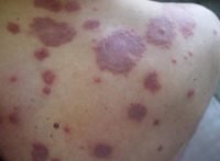 Acute Myeloid Leukemia - Prognosis, Life Expectancy, Survival Rate