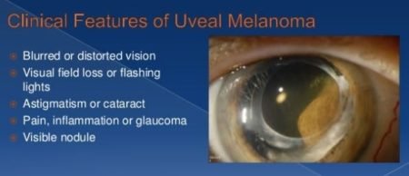 Ocular Melanoma - Symptoms, Pictures, Survival Rate, Prognosis, Treatment