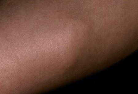 Angiolipoma - Images, Symptoms, Treatment, Removal, Causes, Types