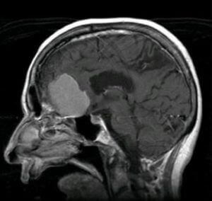Inoperable Brain Tumor - Life Expectancy, Symptoms, Causes, Treatment