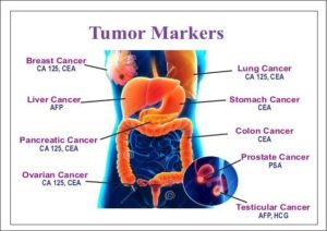CEA Tumor Marker - Normal Ranges, Elevated Levels, Lung Cancer