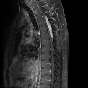 Angiolipoma - Images, Symptoms, Treatment, Removal, Causes, Types