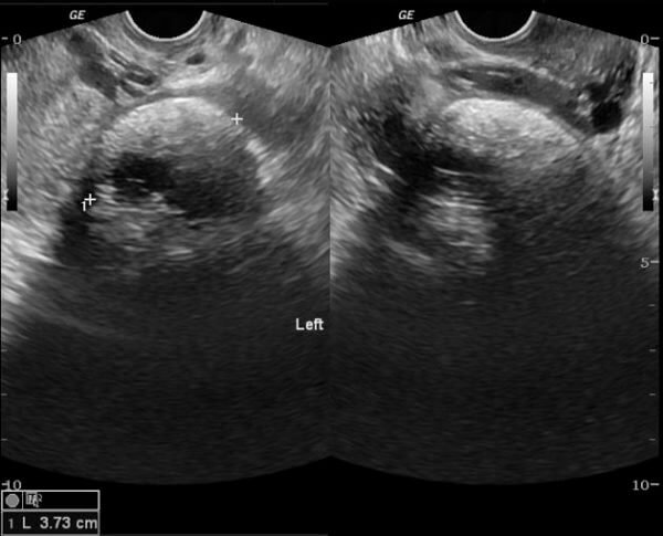 Ovarian Teratoma Symptoms Signs Pictures Causes Mature