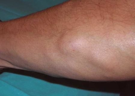 Angiolipoma - Images, Symptoms, Treatment, Removal, Causes, Types