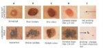 Precancerous Mole - Treatment, Surgery, Stages, Pictures