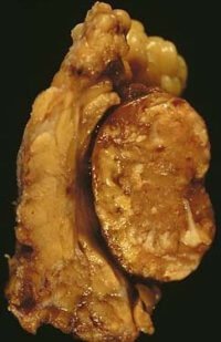 Warthin Tumor - Treatment, Prognosis, Causes, Diagnosis, Symptoms