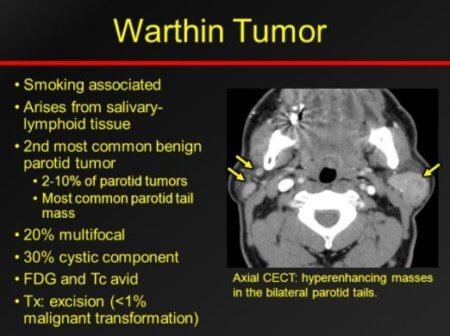Warthin Tumor - Treatment, Prognosis, Causes, Diagnosis, Symptoms