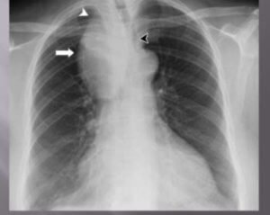 Thymoma - What is?, Definition, Stages, Symptoms, Diagnosis, Prognosis